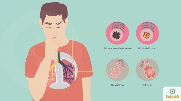 Penyakit Paru Obstruktif Kronis (PPOK) yang Menjadi Ancaman bagi ...