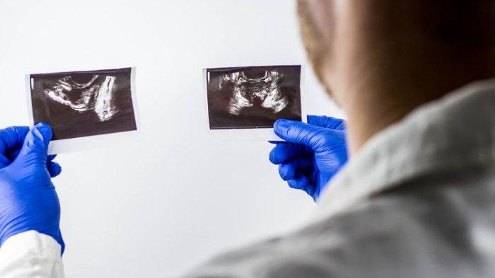 Penyebab Umum Gangguan Prostat, dr. Rizki Muhammad Ihsan Sp.U Jelaskan ...