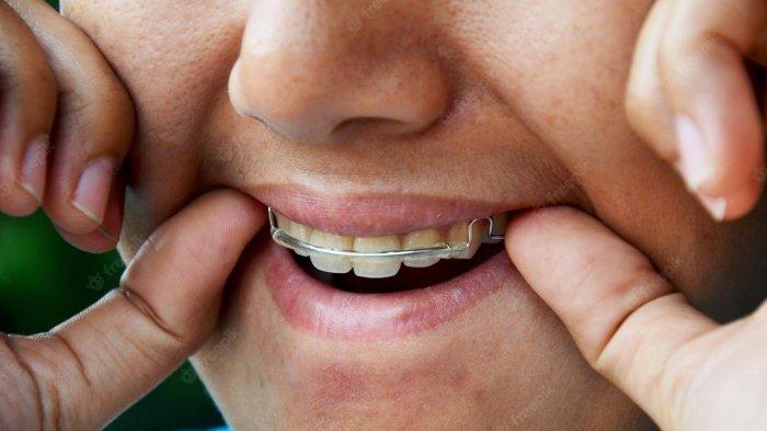 Berapa Lama Waktu yang Dibutuhkan dalam Penggunaan Retainer? Ini ...