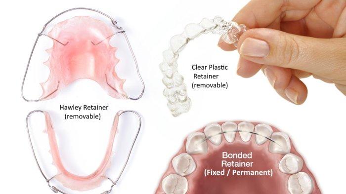 drg. Ardiansyah Pawinru Sp.Ort Jelaskan Jenis Retainer Gigi yang Sering ...