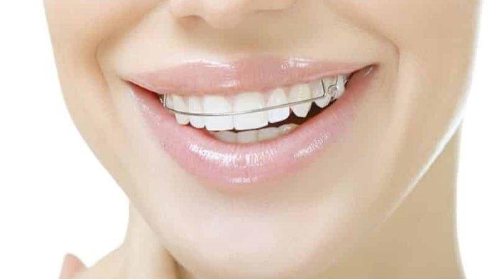 Pahami Kekurangan dan Kelebihan dari Masing-masing Retainer Berdasarkan ...