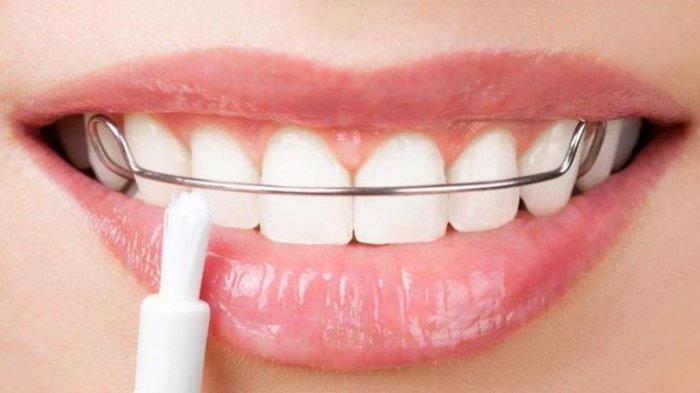 Apa Itu Retainer Gigi? Begini Penjelasan dari drg. Ardiansyah S ...