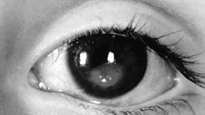 Sebelum Terjadi Ulkus Kornea, Apa yang Dikeluhkan Pasien? Simak ...