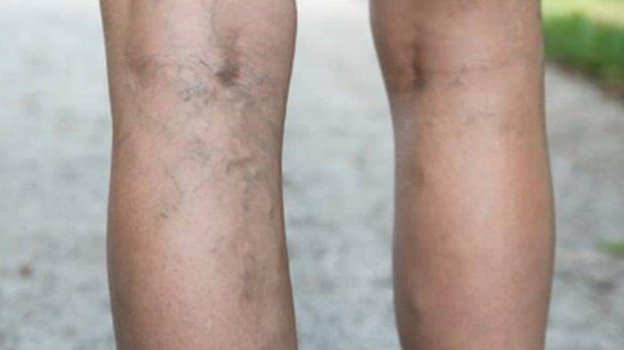 Mengenal Varises, Pembuluh Darah Berukuran Besar dan Berbentuk seperti ...