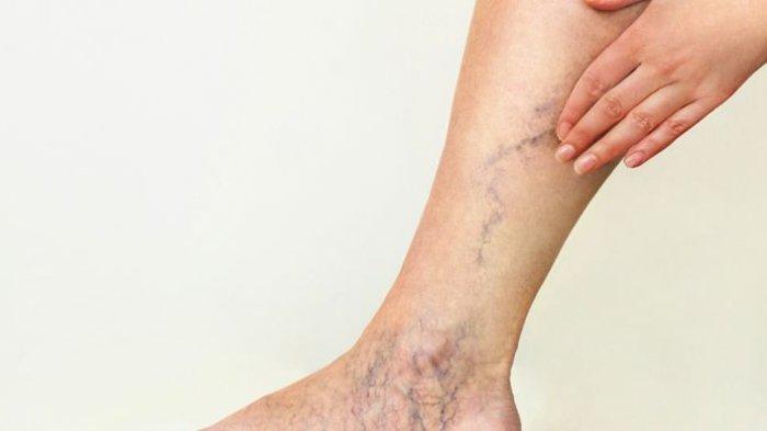 Kenali Penyakit Varises Beserta Penyebabnya yang Disampaikan dr. Novi ...