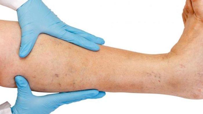 Tak Hanya di Kaki Saja, Varises Bisa Terjadi di Bagian Tubuh Lainnya ...