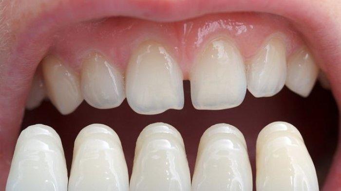 Pemasangan Veneer Tak Hanya Memerhatikan Estetika Saja, Namun juga ...