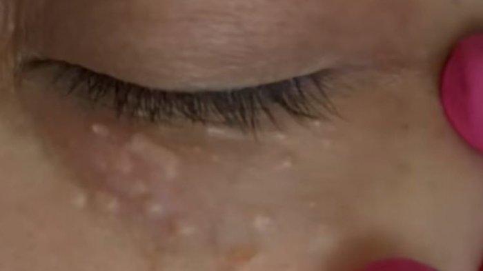 Xanthomatosis Adalah