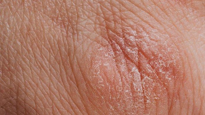 Seseorang dengan Riwayat Dermatitis Atopi Bisa Alami Xerosis Cutis ...