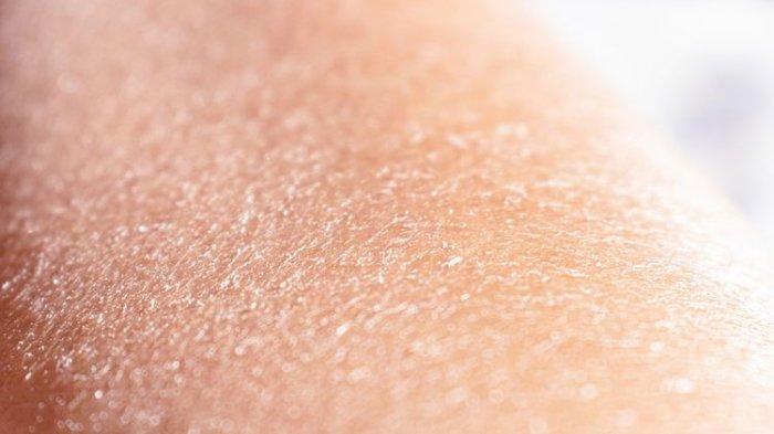 dr. Mira Trisna Murti, Sp.DV Paparkan Penyebab dari Xerosis Cutis ...