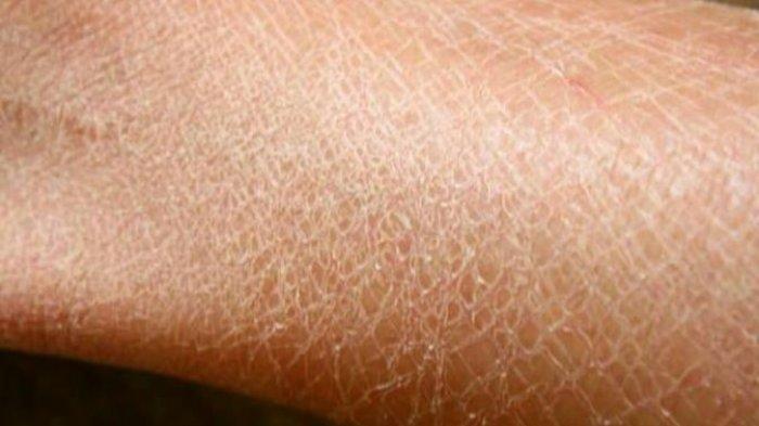 dr. Mira Trisna Murti Paparkan Cara Pencegahan dan Pencegahan Xerosis ...