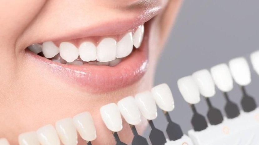 drg. R. Ngt Anastasia Jelaskan Perbedaan Veneer dan Bleaching Gigi ...