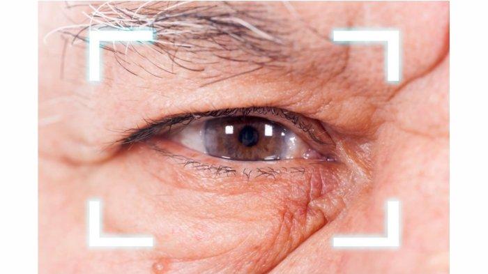 Katarak Sekunder Muncul Setelah Operasi Katarak, Harus Operasi dua kali ...