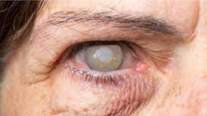 Mengenal Lebih Dalam Katarak, Gejala, Penyebab dan Pengobatan ...