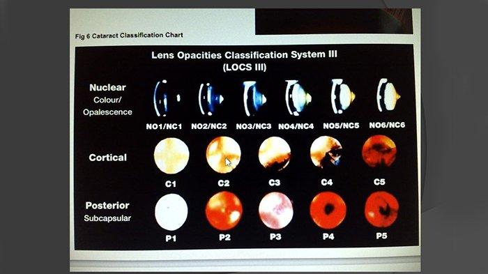 Klasifikasi Katarak - Tribunjabar.id