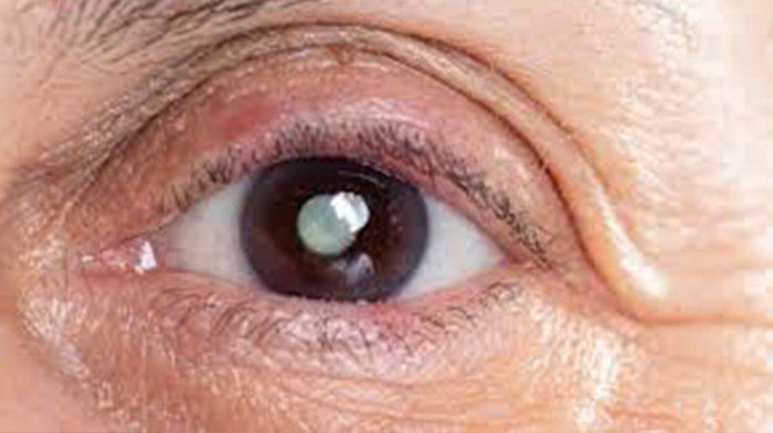 Mengenal Katarak Traumatik Serta Penanganannya - Tribunjabar.id