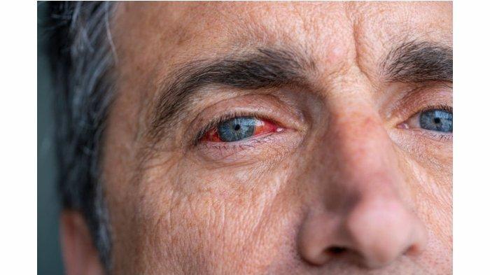 Waspada Glaukoma Sekunder yang Bisa Sebabkan Kebutaan - Tribunjabar.id