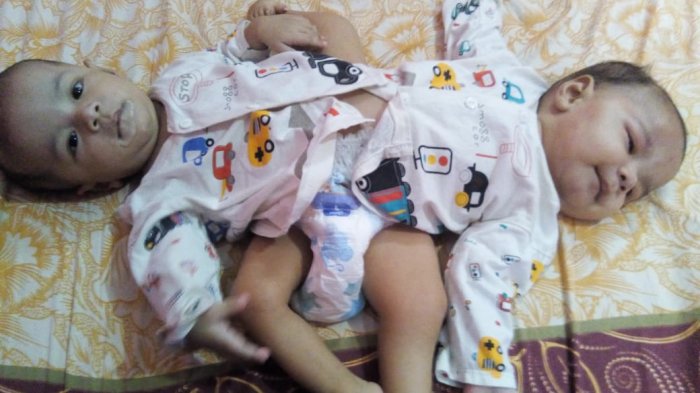 Persiapan Operasi Pemisahan, Bayi Kembar Siam Asal Subang Jalani CT Scan Besok - Tribunjabar.id
