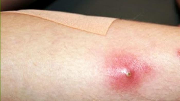 Duh . . . Benarkah Bisulan Terjadi Karena Mengonsumsi Telur ...