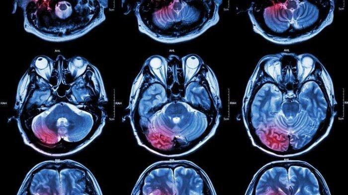Gejala Paling Umum yang Dialami Penderita Tumor Otak, Ini Penjelasannya - Tribunjabar.id