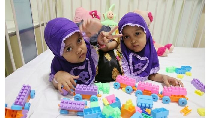 Kisah Anak Kembar Siam Asal Garut Sempat Disembunyikan Sang Ayah dari ...