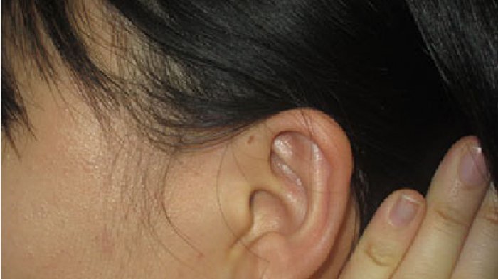 Memahami Sinus Preauricular, Lubang Kecil di Telinga yang Disebut Sisa ...