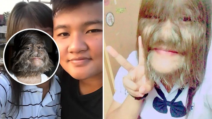 Dulu Dihina, Wanita yang Dijuluki Manusia Serigala ini Sekarang Sudah ...