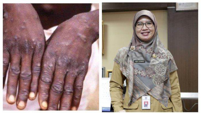 Catat! Pesan Dinkes Depok Buat Warganya Imbas Temuan Cacar Monyet di Jakarta - Tribunjakarta.com