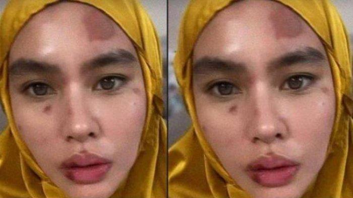 Penyebab Muka dan Bibir Kartika Putri Melepuh, Ternyata Karena Penyakit ...