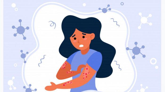 Punya Gejala Mirip, Ini 7 Perbedaan Cacar Monyet, Cacar Air dan Cacar Biasa - Tribunjakarta.com