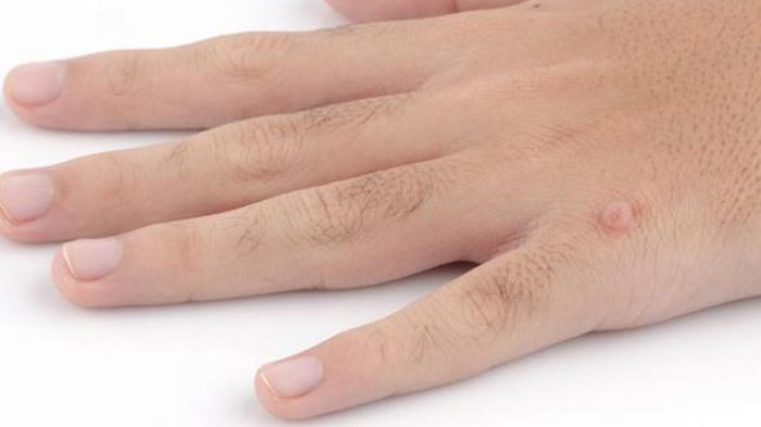 Cara Alami Menghilangkan Kutil, dr Zaidul Akbar Bagikan resepnya ...