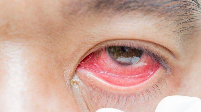 Cara Alami Obati Sakit Mata hingga Mata Rabun, dr Zaidul Akbar Bagikan ...