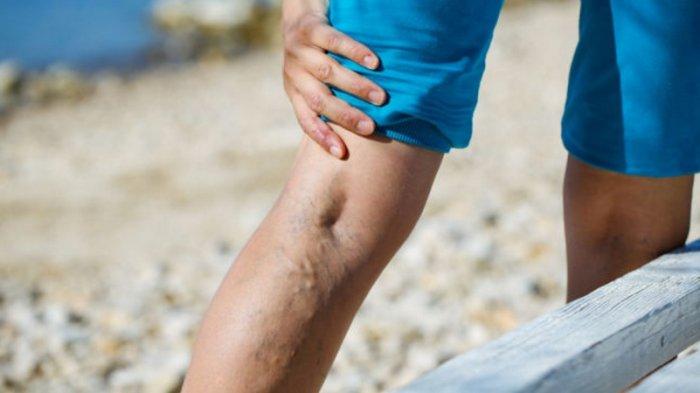 Apa Itu Varises? Gangguan Kesehatan yang Bisa Dipicu Karena Terlalu ...