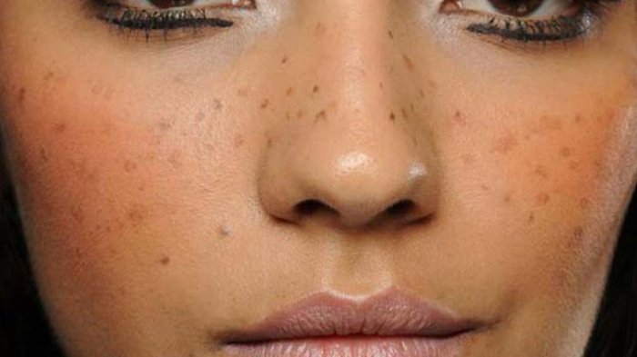 Cara Menghilangkan Flek Hitam di Wajah Secara Alami, Coba 6 Obat ...