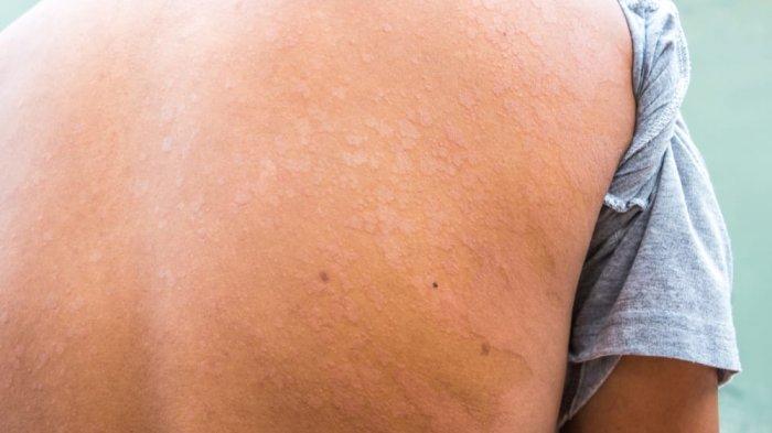 Cara Menghilangkan Panu, Pengobatan Bisa Dilakukan di Rumah ...