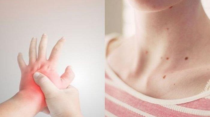 Gejala Penyakit Mematikan yang Kerap Diabaikan, Mulai Tahi Lalat hingga ...