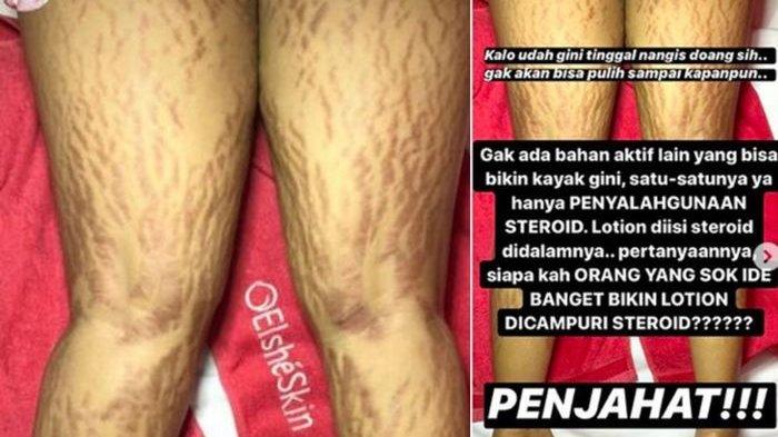 Salah Pilih Lotion, Kulit Kaki Wanita Penuh Stretch Mark Merah ...