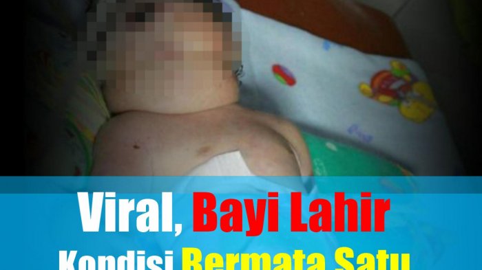 VIDEO: Heboh Bayi Lahir Kondisi Bermata Satu dan Tanpa Hidung, Sang Ibu ...