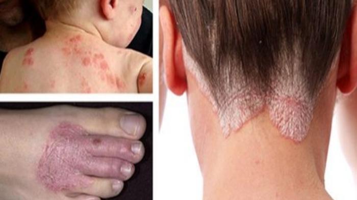 Penyakit Eksim - Kenali Penyebabnya, Jangan Sampai Salah Kaprah ...