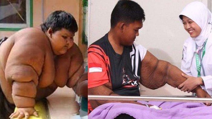 Dulu Obesitas, Arya Permana Kini Jalani Operasi Angkat Kulit Gelambir ...