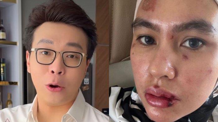 Dokter Richard Lee Komentari Wajah hingga Lidah Kartika Putri yang ...