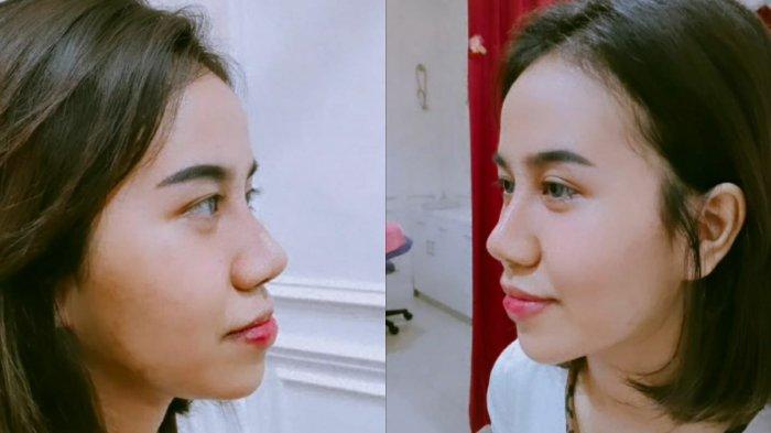 Penampilan Baru Mayang Pasca Operasi Hidung Tuai Hujatan Netizen: Kok ...