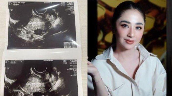 Tiba-tiba Dewi Perssik Pamer Hasil USG hingga Singgung Soal Mandul ... Tiba-tiba Dewi Perssik Pamer Hasil USG hingga Singgung Soal Mandul ...