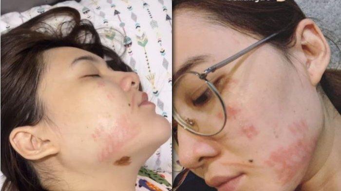 Wajah Nella Kharisma Rusak Penuh Bercak Merah Gegara Diserang Tomcat ...