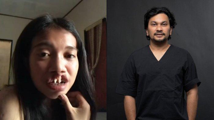 Dokter Tompi Cari Sosok Rista Junianti, Niat Beri Operasi Bibir Gratis: Kalau Ada yang Kenal ...