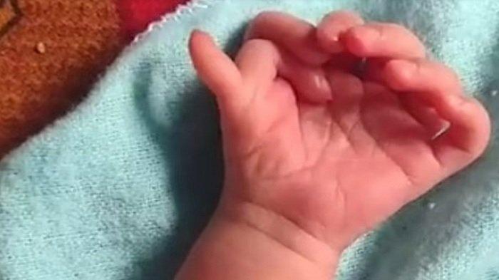Potret Bayi di India Lahir dengan 26 Jari, Disebut Titisan Dewi ...