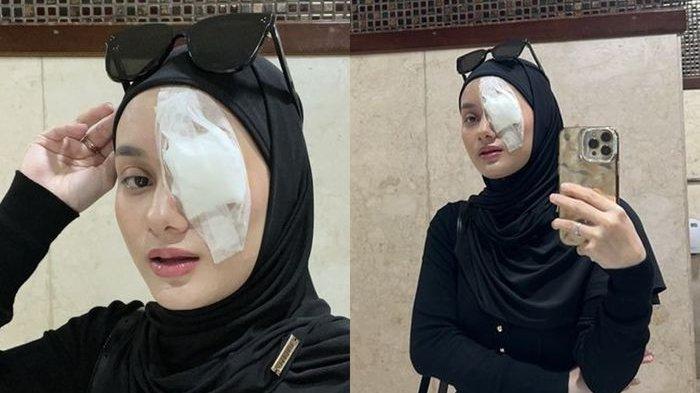 Kabar Pilu Dinda Hauw Pakai Perban di Area Wajah, Ternyata Kena Kista ...