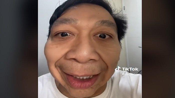 Viral! Daffa & Puspa Alami Sindrom Werner, Usia 20 Tahunan Penuaan ...