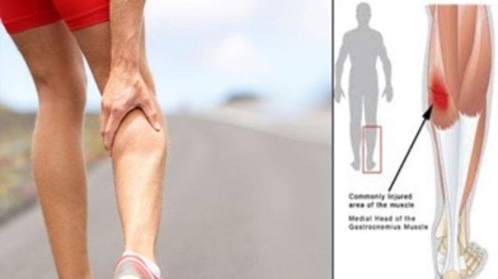 Upaya Penanganan dengan Metode "Peace & Love" pada Cedera Otot ...