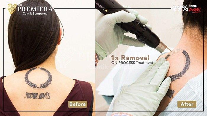 Hapus Tato Permanen yang Disesali dengan Mudah di PREMIERA Skin ...